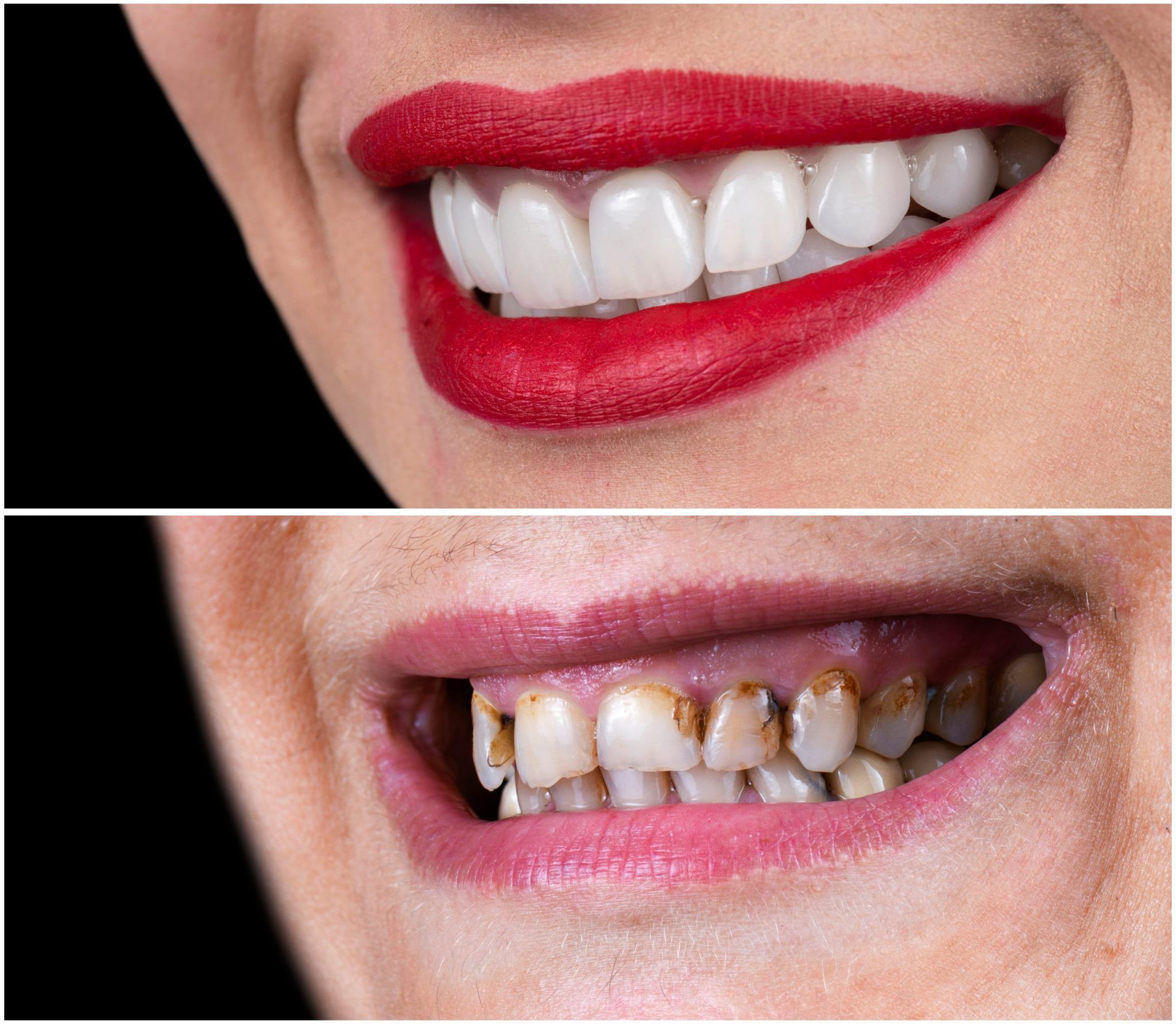 The Costs of Full Mouth Dental Implants | Prof Clinic